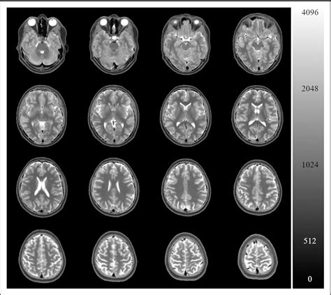 Figure 1 From First Clinical Application Of A Novel T1 Mapping Of The