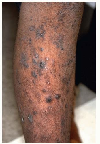 Evaluation Of Pruritus Anesthesia Key