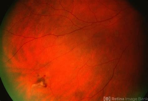 Peripheral Retinal Tear Retina Image Bank