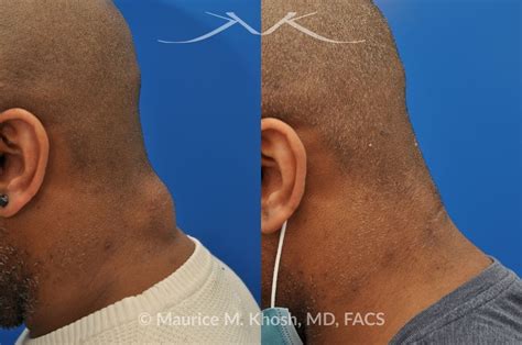 Lipoma Photo Gallery Maurice M Khosh Md Facs