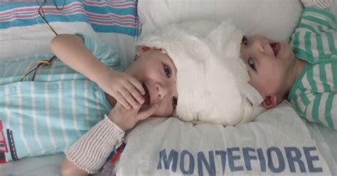 [월드피플 ] 서로 머리 붙어 태어난 샴쌍둥이 분리 수술 그후