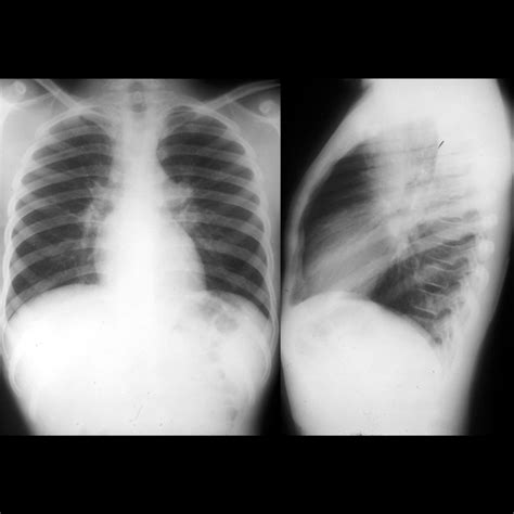 Pediatric Sarcoidosis Pediatric Radiology Reference Article