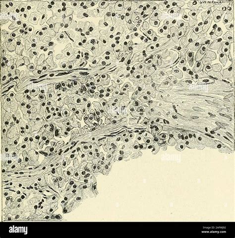 Studies On Hypertrophy And Cancer Of The Prostate Fig 12— Case 13