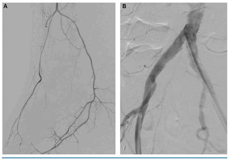 Limb Salvage Endovascular Technique In Chronic Limb Threatening