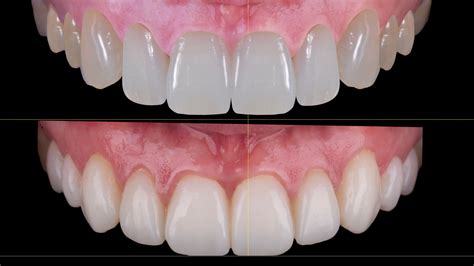 The Perfected Injection Moulding Technique Ipp