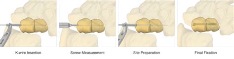 Scaphoid Screw Fracture Treatment Implant Trimed Inc Scaphoid Screw Fracture Treatment Implant Trimed Inc