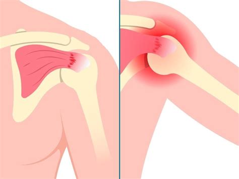 San Jose And Los Gatos Shoulder Bursitis Treatment Dr Pamela Mehta