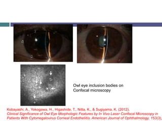Viral Keratitis Diagnosis And Management Pptx