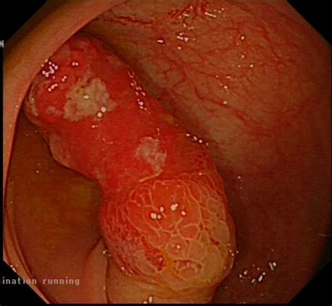 Caecal Polyp Inverted Appendix With Wide Ulceration Download Scientific Diagram