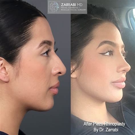 Ultrasonic Piezo Rhinoplasty Dr Shahrouz Zarrabi MD