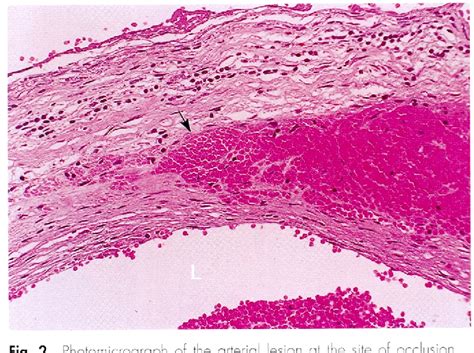 Dissecting Aneurysm Of The Posterior Cerebral Artery