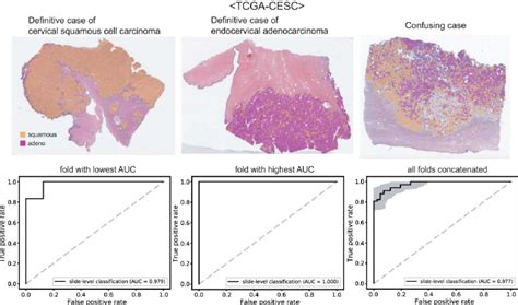 Figure 1 From Deep Learning Based Classification Of Uterine Cervical And Endometrial Cancer
