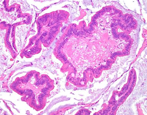 Mucinous Carcinoma Of The Colon Photograph By Webpathologyscience