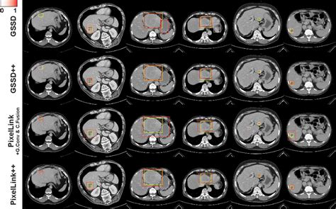 figure 4 from robust end to end focal liver lesion detection using