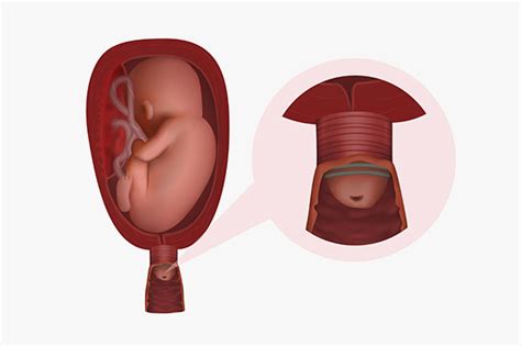 Cervical Cerclage Prevent Preterm Birth And Miscarriage
