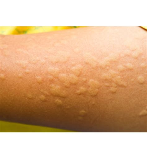 Urticaria Rashes