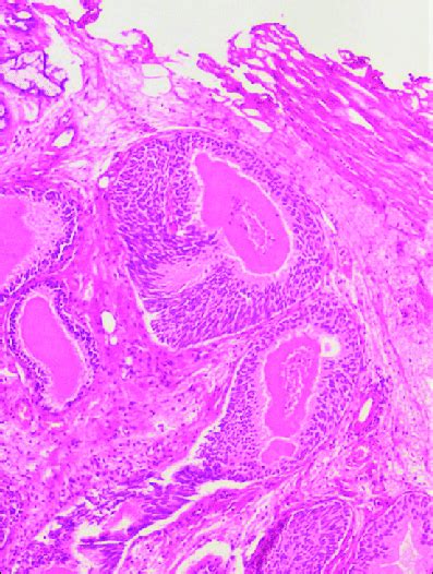 Cystitis Cystica Et Glandularis Showing A Typical Columnar Lined