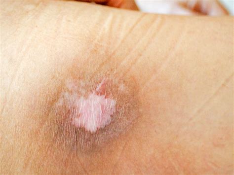 Bedsores Pressure Ulcers Treatments Stages Causes And Pictures