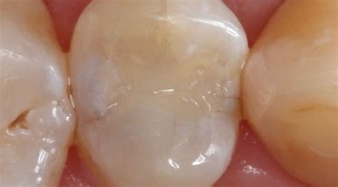 The Clinical And Practice Benefits Of A Single Shade Composite System Dental Economics