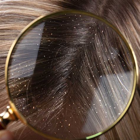 Scalp Problems Common Head Scalp Problems In Hair Parachute Advansed