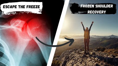 Unlocking Relief Frozen Shoulder Exercises At Home Understanding And