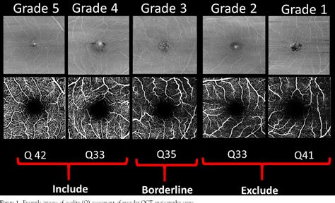 Figure 1 From Quantitative Parameters From Oct Angiography In Patients With Diabetic Retinopathy
