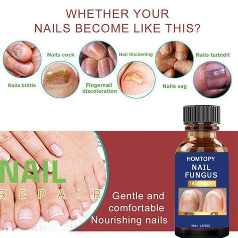 Anti Fungal Treatment Extra Strength Toenail Fungus Athletes Foot Us