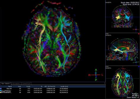 Tractography DTI Diffusion Tensor Imaging MRI Of The Brain Learning Disorder Science Of