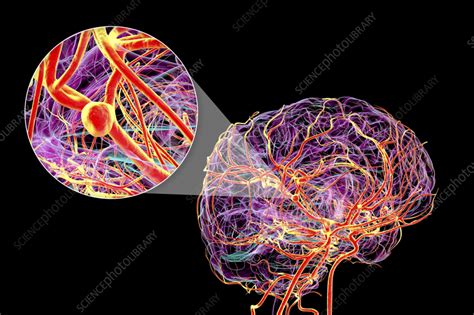 Saccular Brain Aneurysm Illustration Stock Image F0439828 Science Photo Library