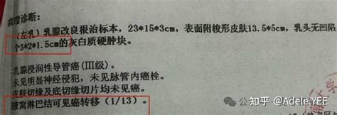 乳腺癌的分期、分型、分期，3分钟读懂乳腺癌病理报告 知乎