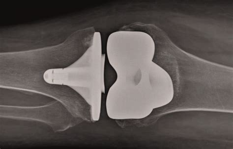 Chirurgia Protesica Di Ginocchio Top Physio