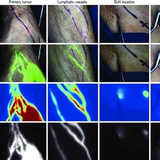 Intraoperative Icg Fluorescence Imaging Of A Patient With Lower