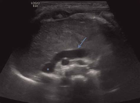 Ultrasound Imaging Of The Normal Appearing Thymus With No Cysts Or