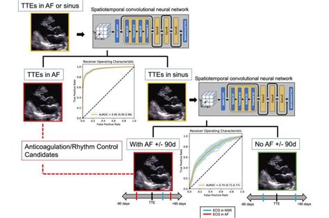 Ai May Help Physicians Detect Abnormal Heart Rhythms Earlier