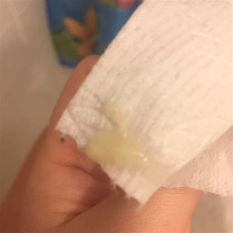 Yellow Clumpy Discharge Sticky Vaginal Discharge All You Need To