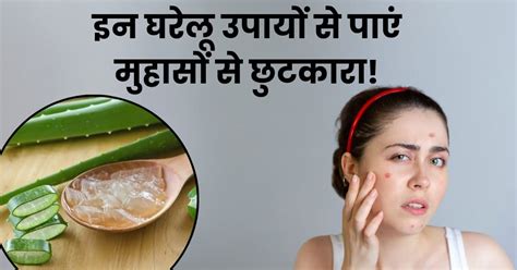 Pimples Se Kaise Chhutkara Paye उमस और पसीने से चेहरे पर निकल रहे हैं