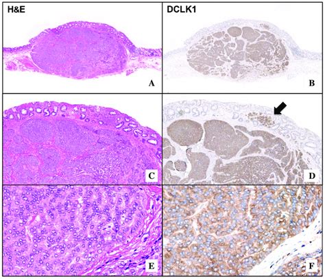 Expression Of Doublecortin Like Kinase 1 Dclk1 In Rectal