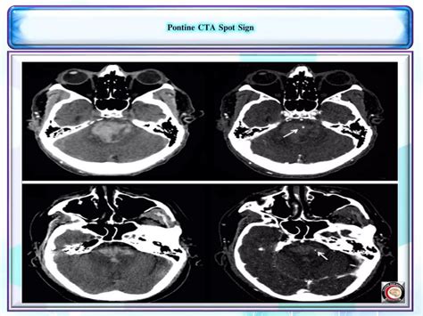 Hematoma Expansion After Spontaneous Intracerebral Hemorrhage Ppt
