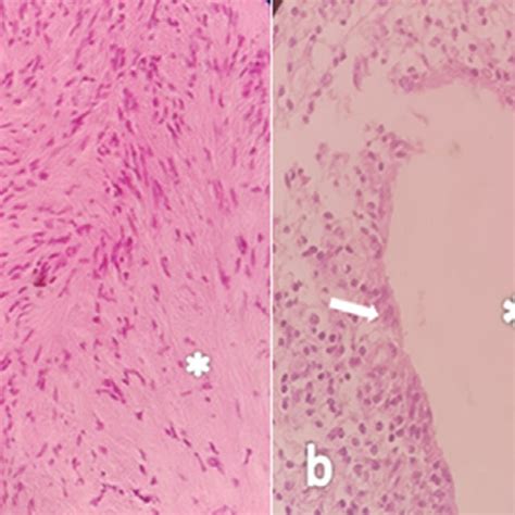 The Histopathological Structure Of The Vestibular Schwannoma In The