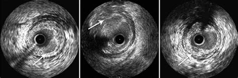 Ntravascular Ultrasound Cross Sectional Images In Three Different Download Scientific Diagram
