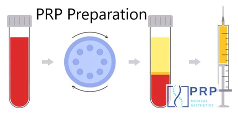 What Is Prp Medical Breakthrough A Complete Guide