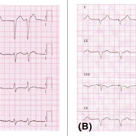 Pre A And Post Crt B 12‐lead Ecgs Note Pre‐ And Post‐crt‐d Qrs