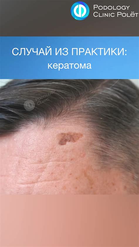 КЛИНИКА ПОДОЛОГИИ ПОЛЁТ СЛУЧАЙ ИЗ ПРАКТИКИ удаление кератомы