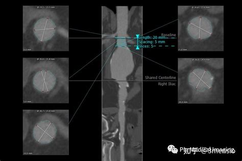 3mensio vascular 知乎