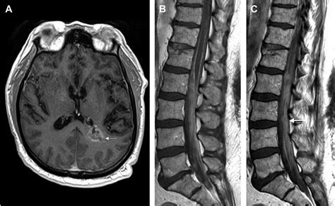 Intradural Extramedullary Tumors And Associated Syndromes Neuroimaging Clinics