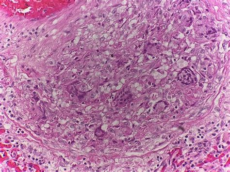 Pulmonary Sarcoidosis R Pathology