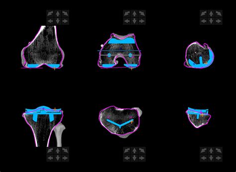 Mako Robotic Assisted Knee Or Hip Replacement Scan Plan Mako Can