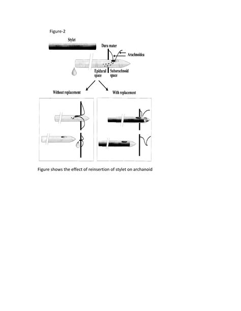 Patho Phsiology Of Pdph Doc