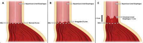 Irregular Z Line To Biopsy Or Not To Biopsy Pubmed