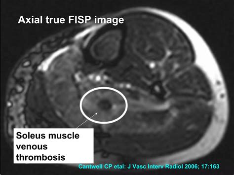 Magnetic Resonance Venography And Venous Ultrasosnography For Diagnosisng
